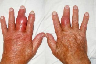 Gout Cấp Tính Là Gì? Biểu Hiện, Nguyên Nhân Và Cách Điều Trị